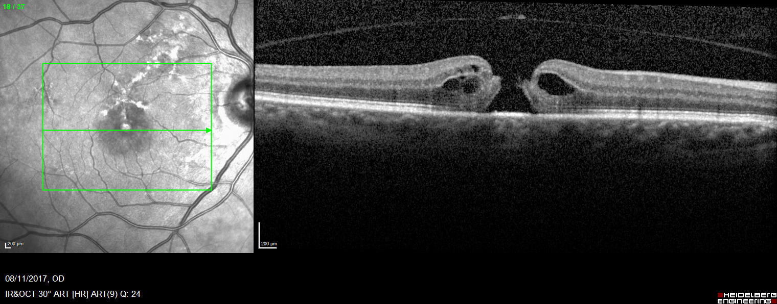 Trou maculaire - Osiris Vision