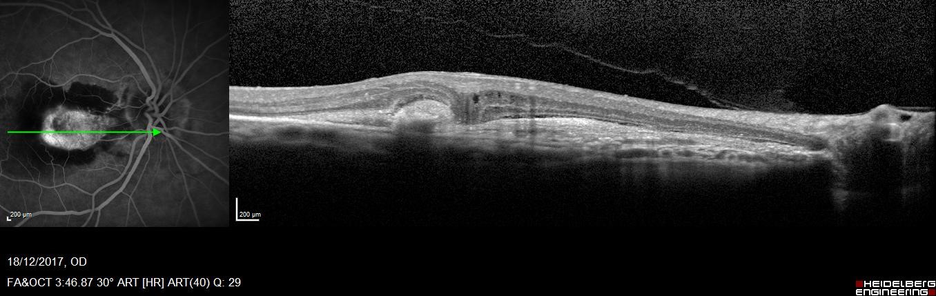 DMLA - Osiris Vision