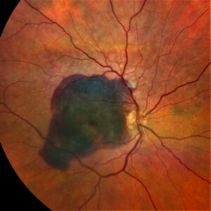 Hématome maculaire - Osiris Vision