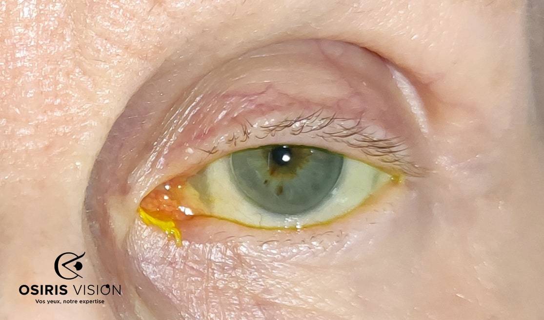 Chirurgie de la paupière - Osiris Vision